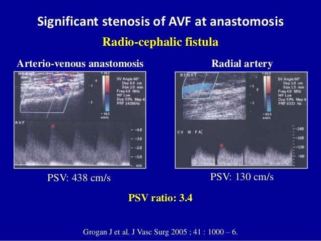 Role of medical imaging in management of arteriovenous fistula Dr. Mu…