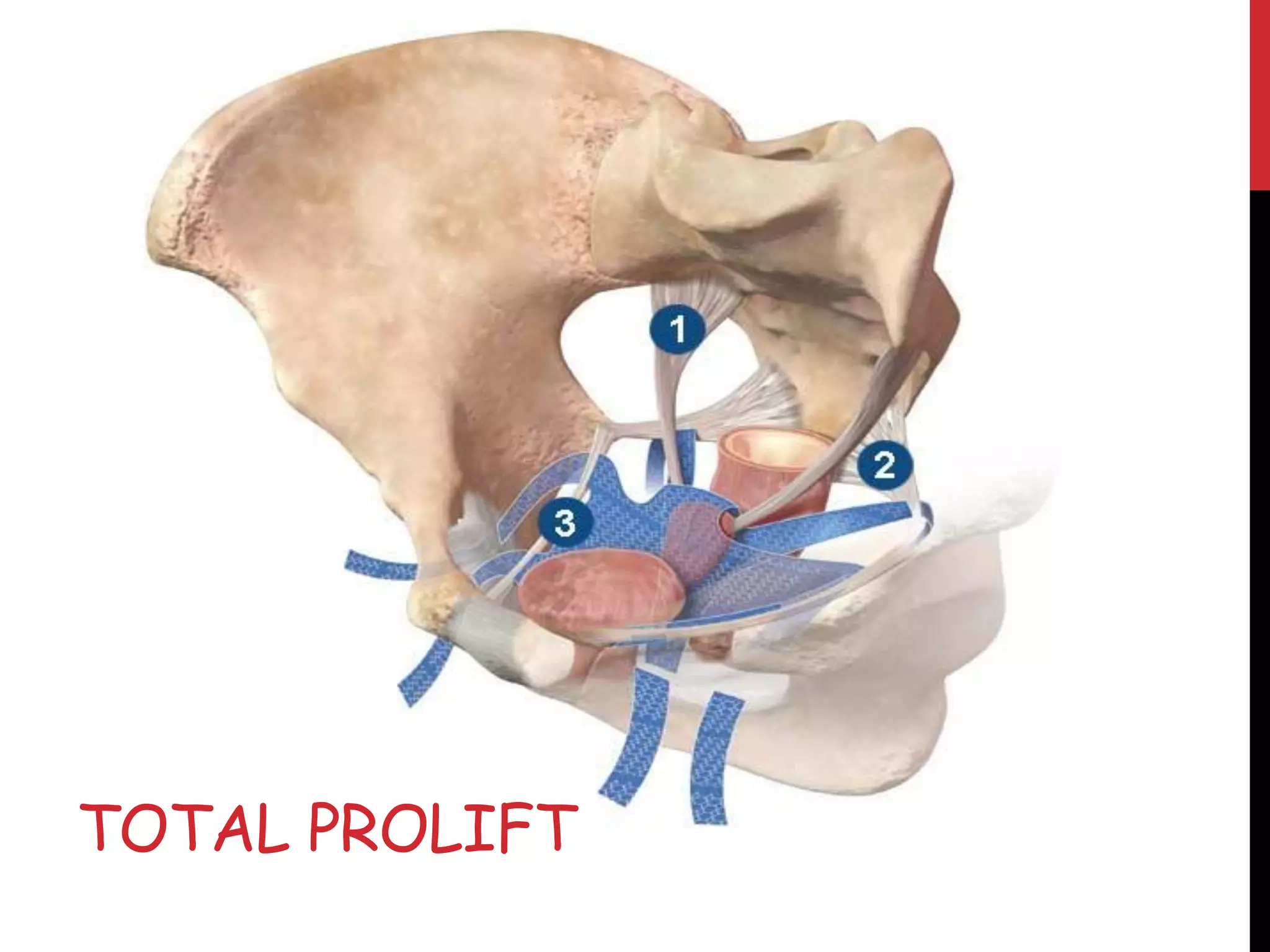 Role of mesh at current practice in urogynae | PDF