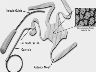 Role of mesh at current practice in urogynae | PDF