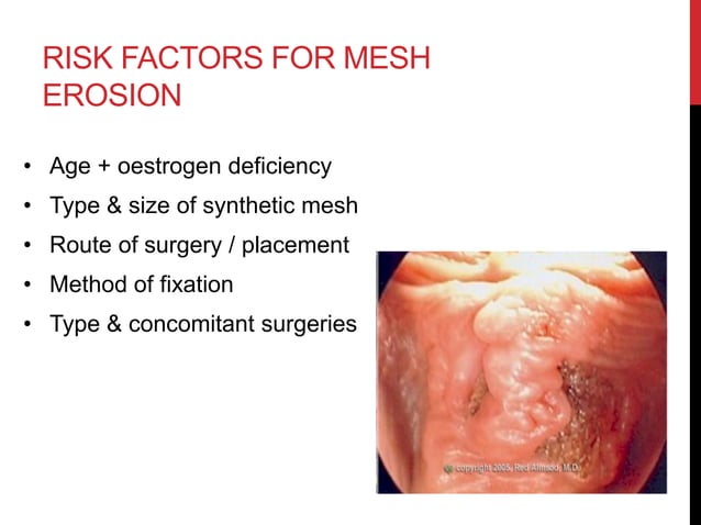 Role of mesh at current practice in urogynae | PDF