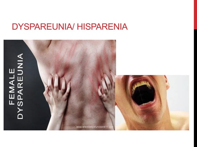 Role of mesh at current practice in urogynae | PDF