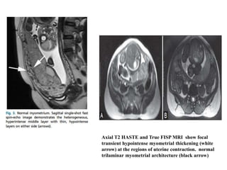 Role of mri in placental disorders new | PPTX