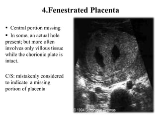 Role of mri in placental disorders new | PPTX