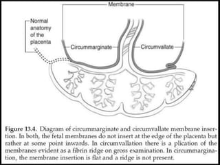 Circummarginate Placenta Ultrasound