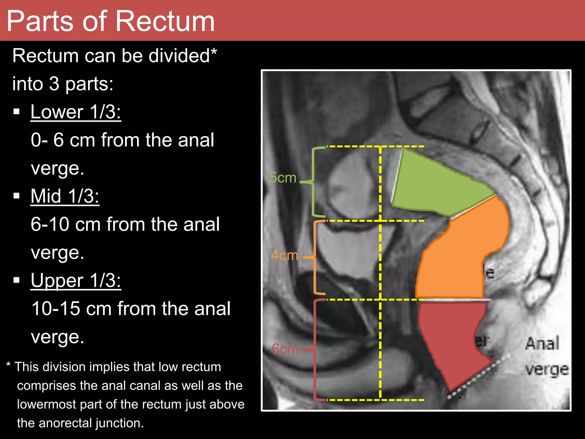 Role of mri in rectal carcinoma | PPTX