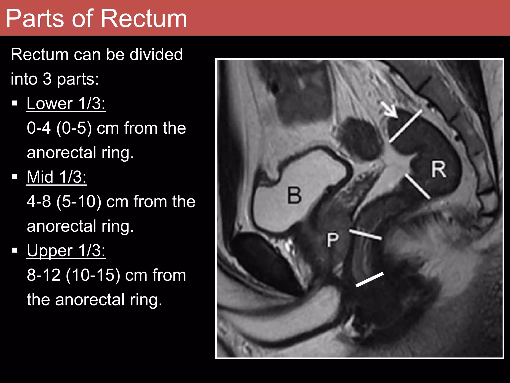 Role of mri in rectal carcinoma | PPTX