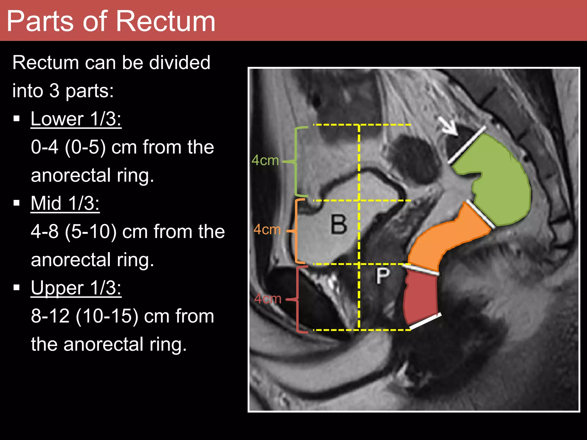 Role of mri in rectal carcinoma | PPTX