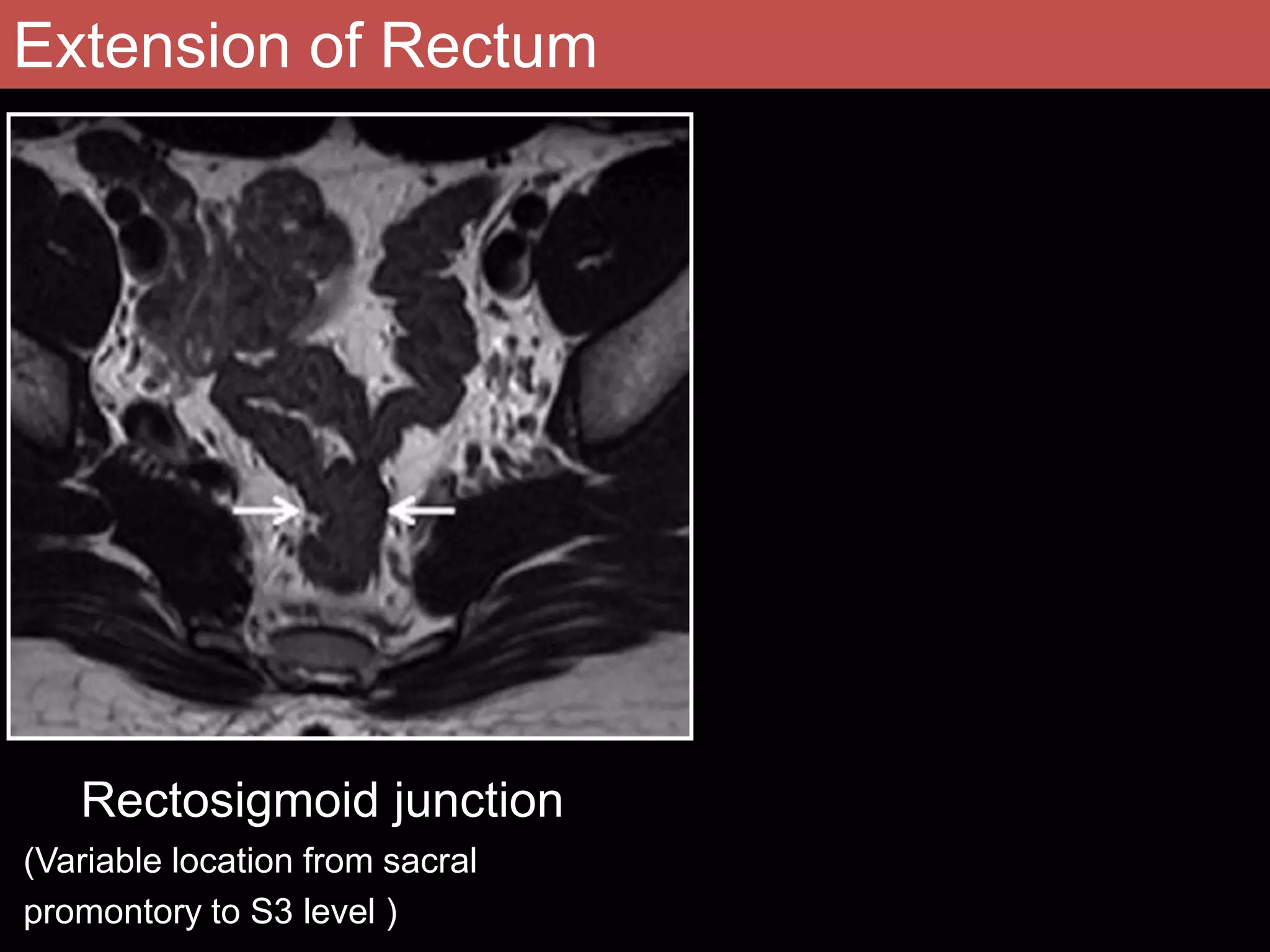 Role of mri in rectal carcinoma | PPTX