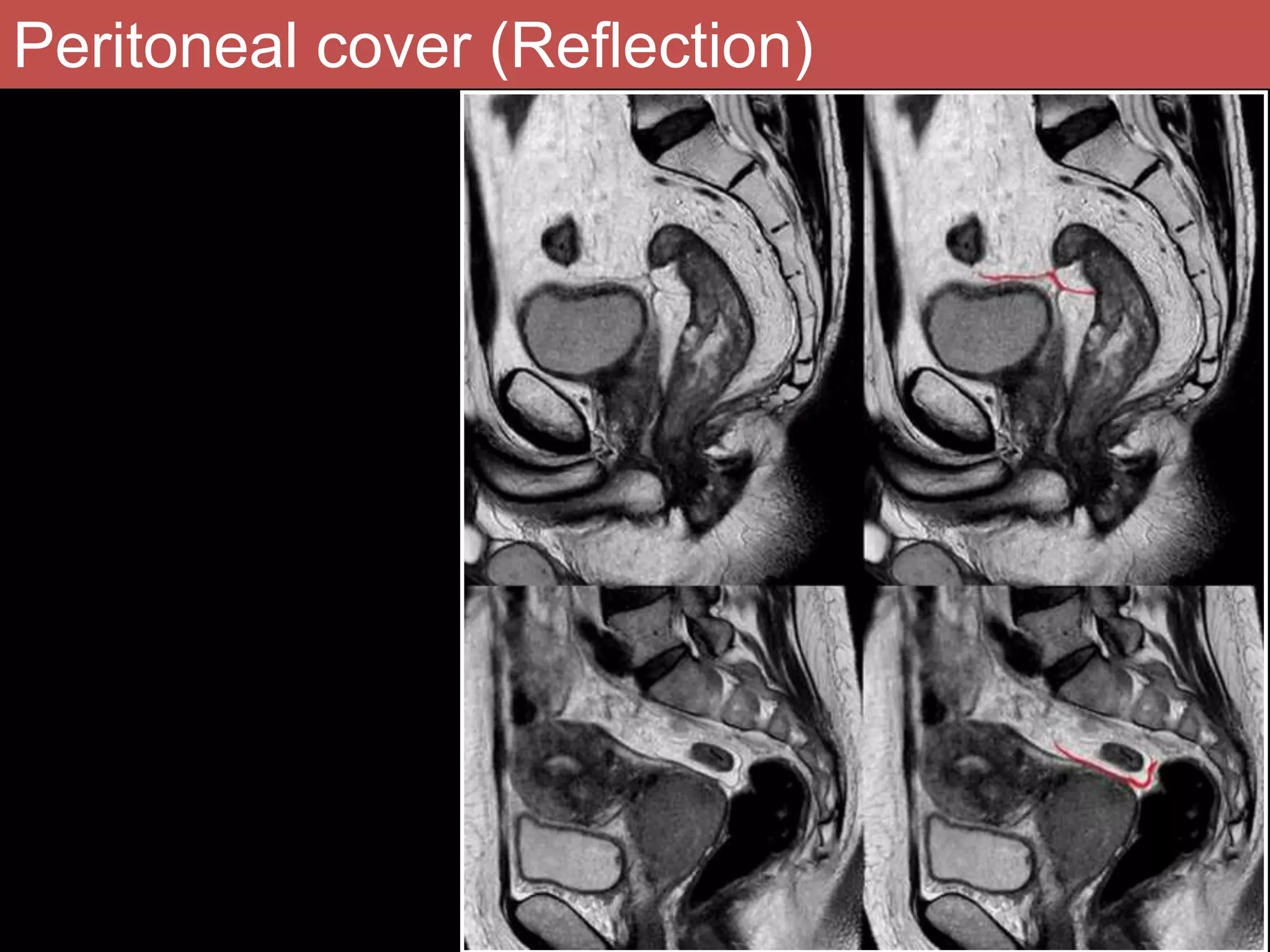 Role of mri in rectal carcinoma | PPTX