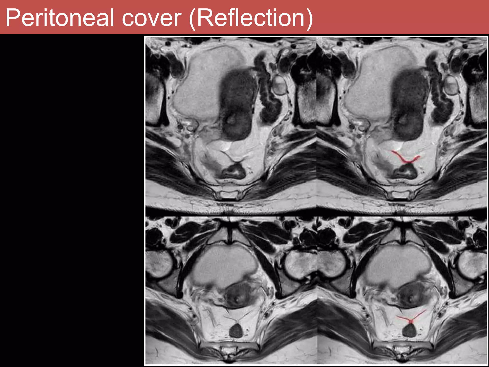 Role of mri in rectal carcinoma | PPTX