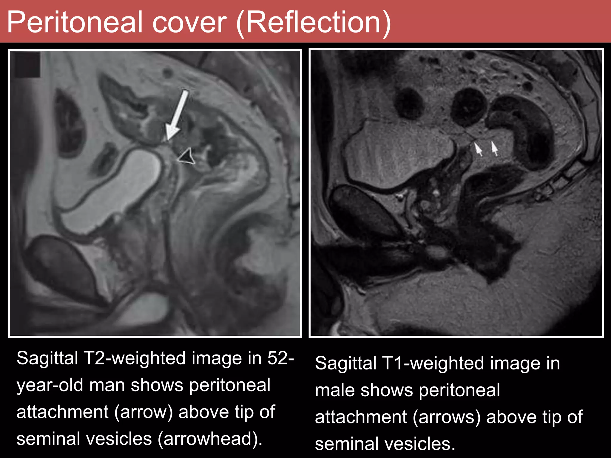 Role of mri in rectal carcinoma | PPTX