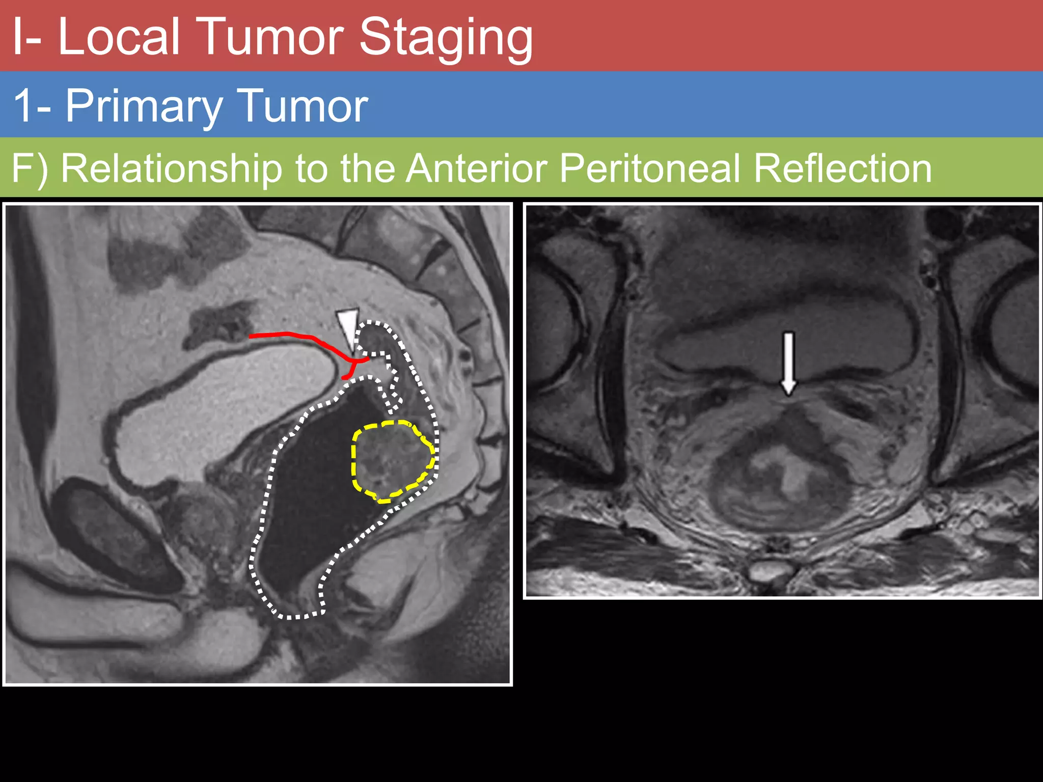 Role of mri in rectal carcinoma | PPTX