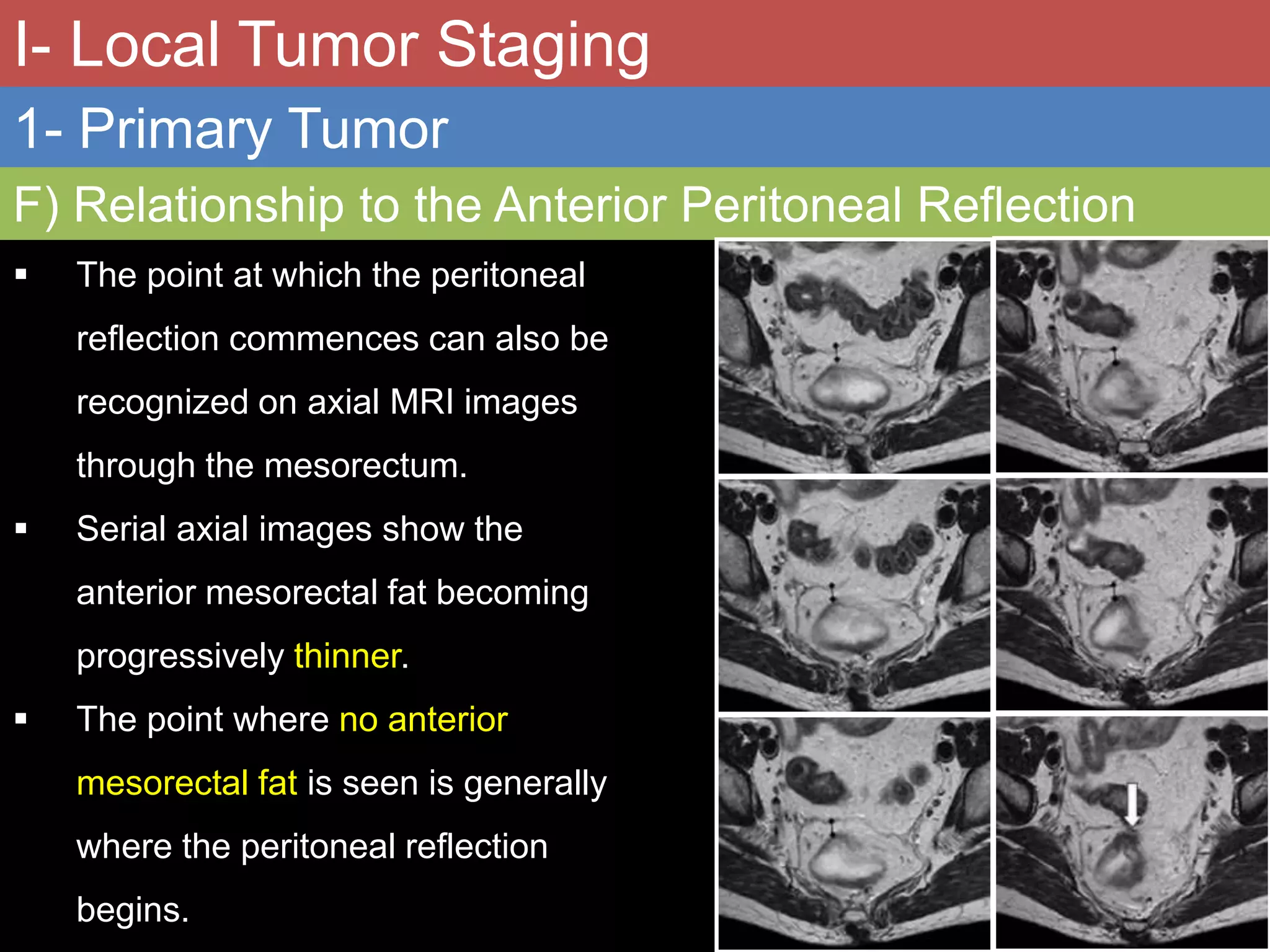 Role of mri in rectal carcinoma | PPTX