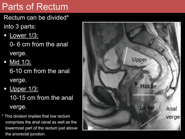Role of mri in rectal carcinoma | PPTX