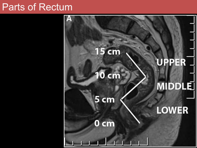Role of mri in rectal carcinoma | PPTX