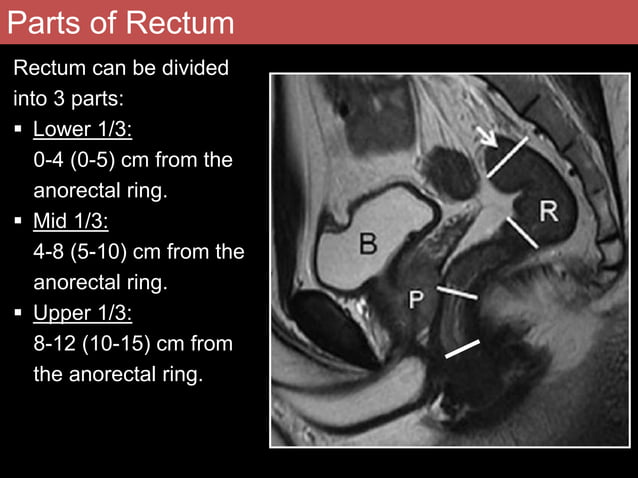 Role of mri in rectal carcinoma | PPTX