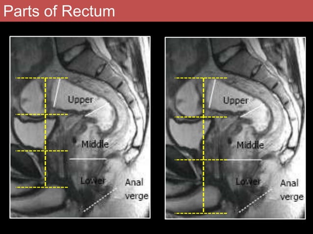 Role of mri in rectal carcinoma | PPTX