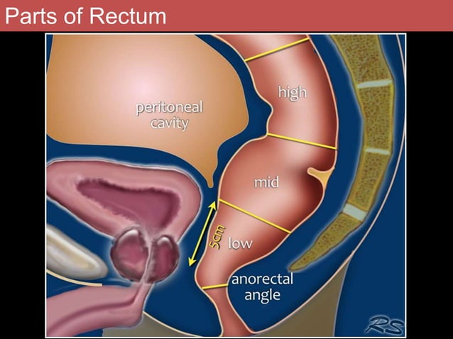 Role of mri in rectal carcinoma | PPTX