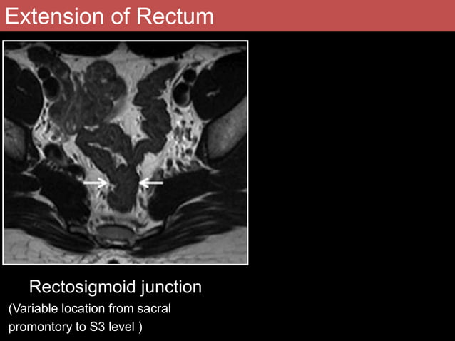 Role of mri in rectal carcinoma | PPTX