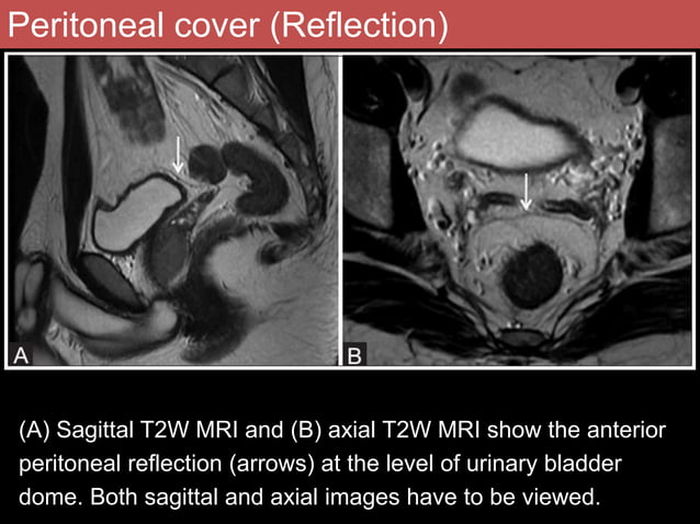 Role of mri in rectal carcinoma | PPTX