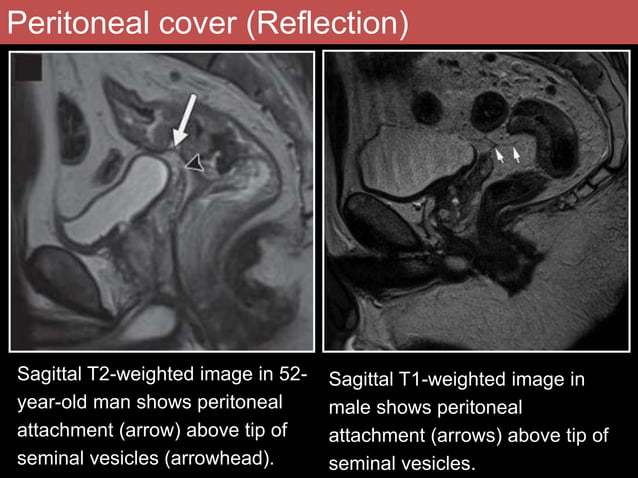 Role of mri in rectal carcinoma | PPTX