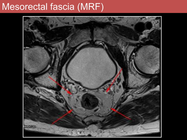 Role of mri in rectal carcinoma | PPTX