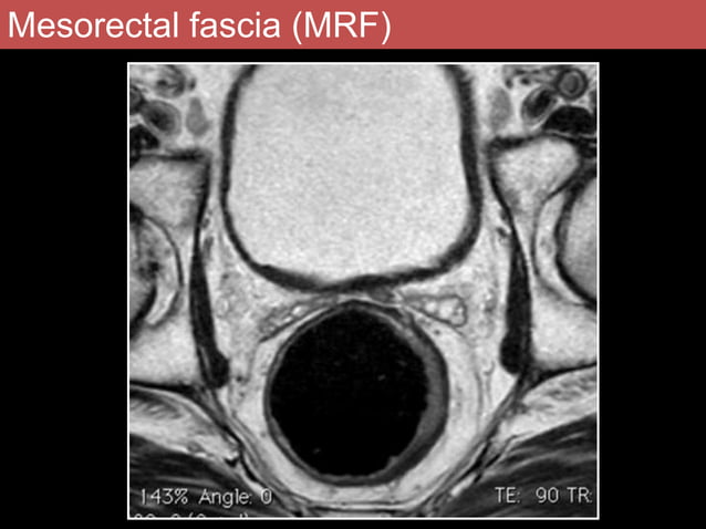 Role of mri in rectal carcinoma | PPTX