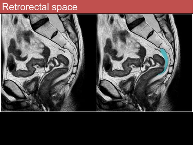 Role of mri in rectal carcinoma | PPTX