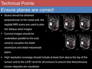 Role of mri in rectal carcinoma | PPTX