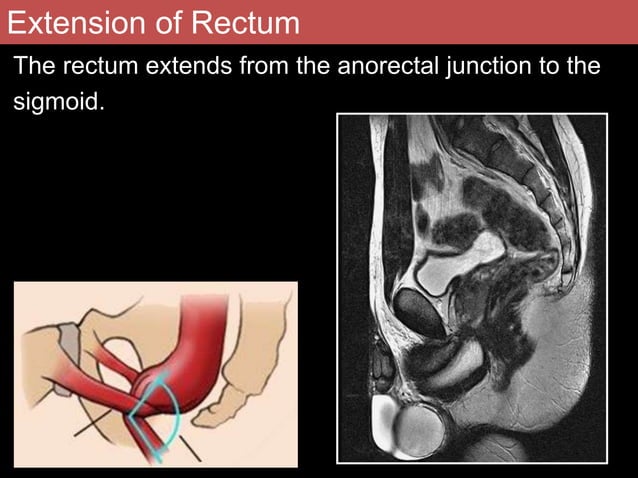Role of mri in rectal carcinoma | PPTX