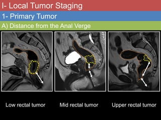 Role of mri in rectal carcinoma | PPTX