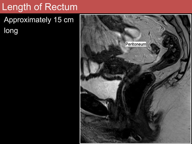 Role of mri in rectal carcinoma | PPTX