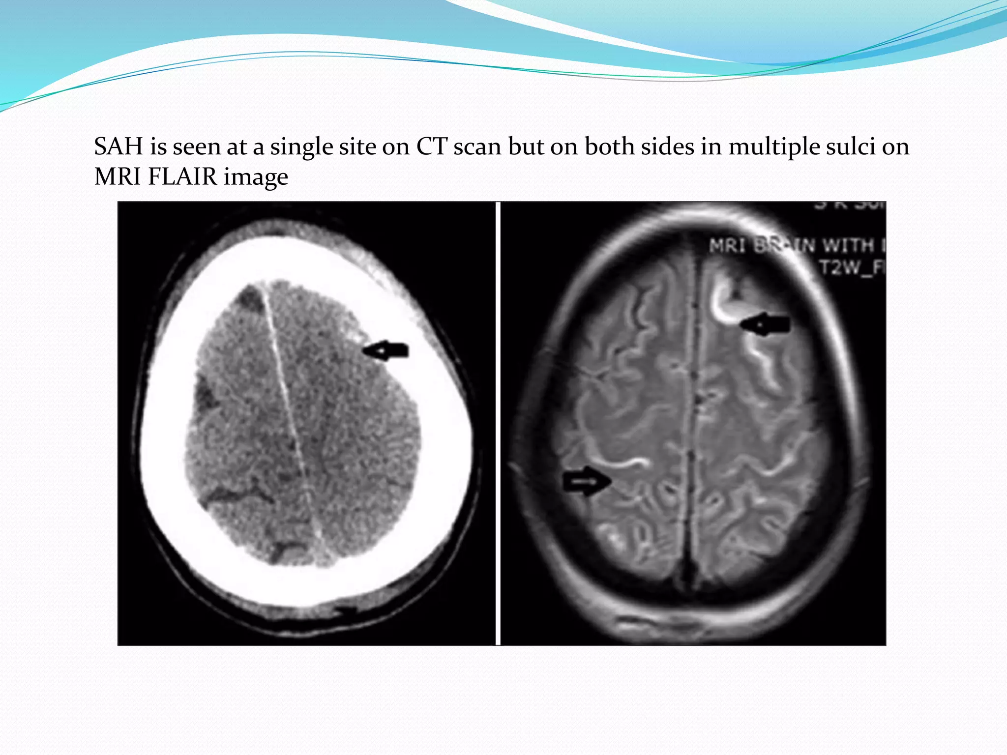 Role of mri in traumatic brain injury | PPTX