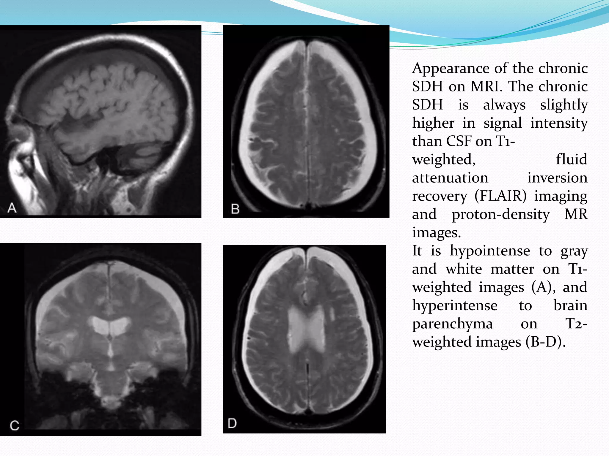 Role of mri in traumatic brain injury | PPTX