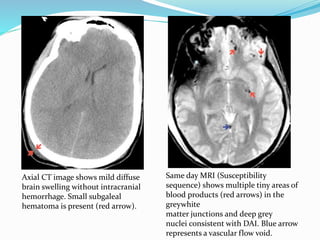 Role of mri in traumatic brain injury | PPTX