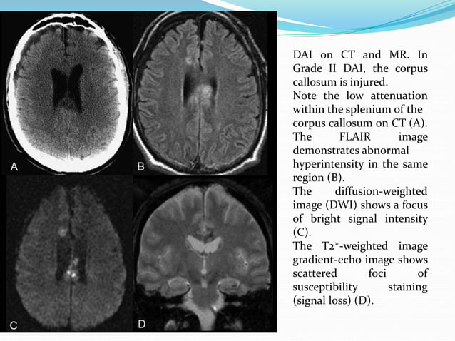 Role of mri in traumatic brain injury | PPT