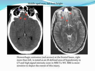 Role of mri in traumatic brain injury | PPT