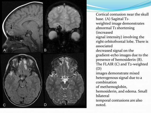 Role of mri in traumatic brain injury | PPT