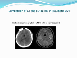 Role of mri in traumatic brain injury | PPT