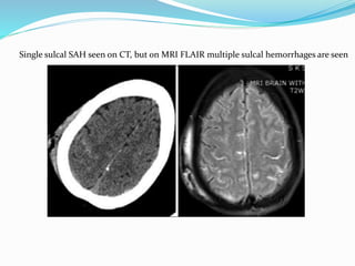 Role of mri in traumatic brain injury | PPT