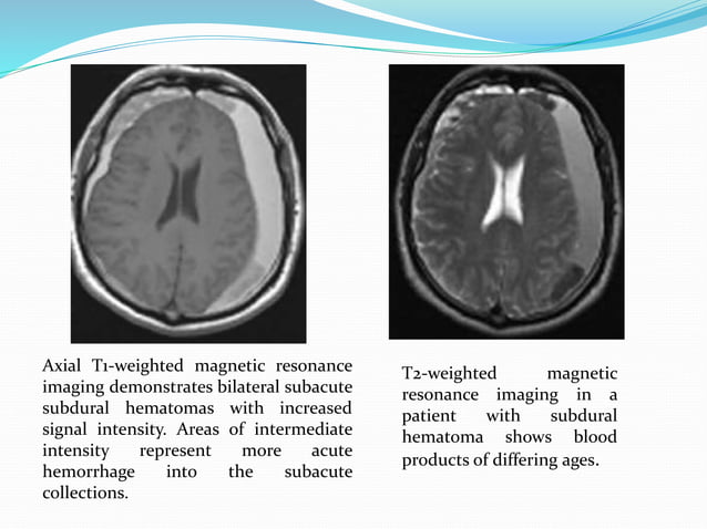 Role of mri in traumatic brain injury | PPT