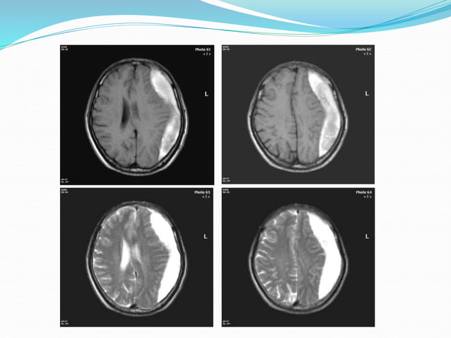 Role of mri in traumatic brain injury | PPT