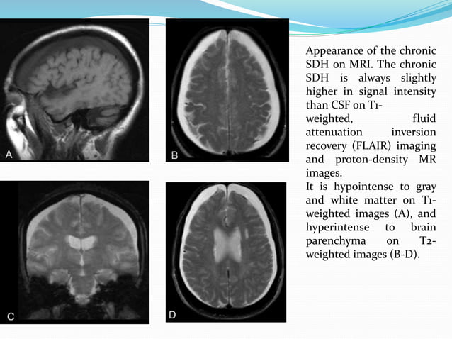 Role of mri in traumatic brain injury | PPT