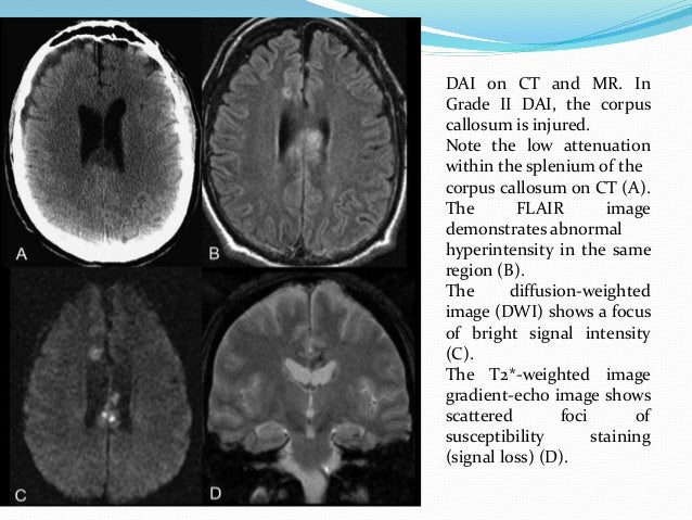 Role of mri in traumatic brain injury