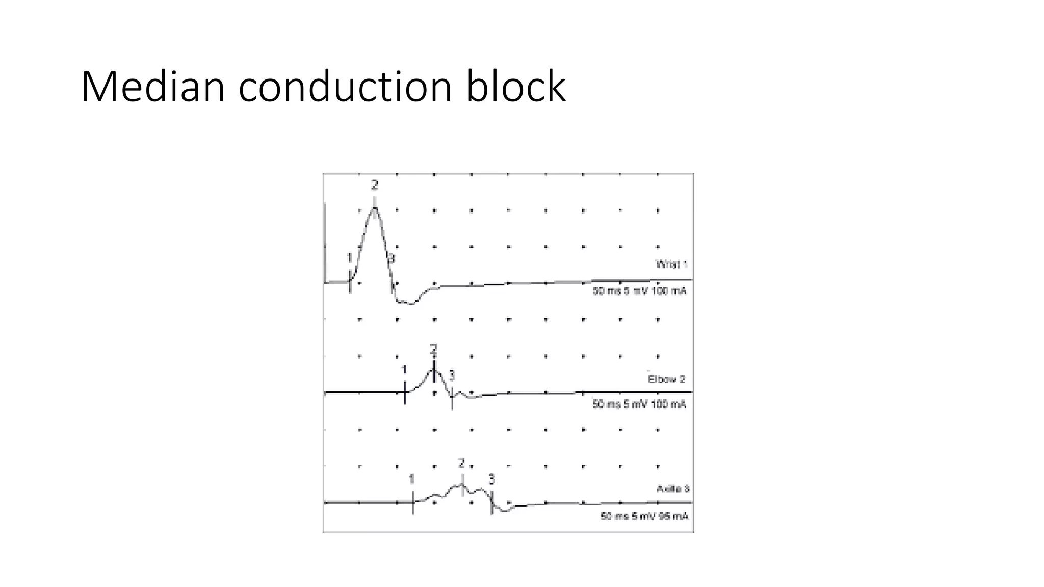 Role of NCS in Nerve injuries.pptx