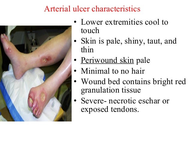 Role of nurse in foot ulcer