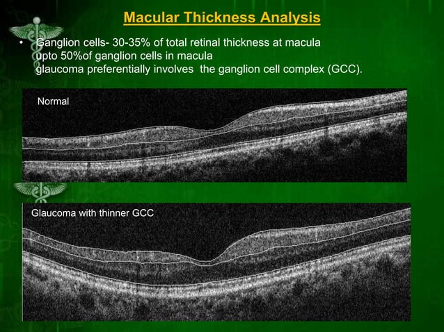 Role of oct in glaucoma | PPTX