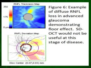 Role of oct in glaucoma | PPTX
