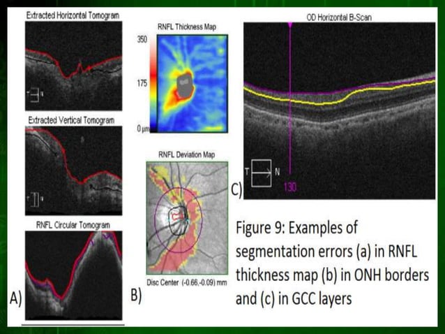 Role of oct in glaucoma