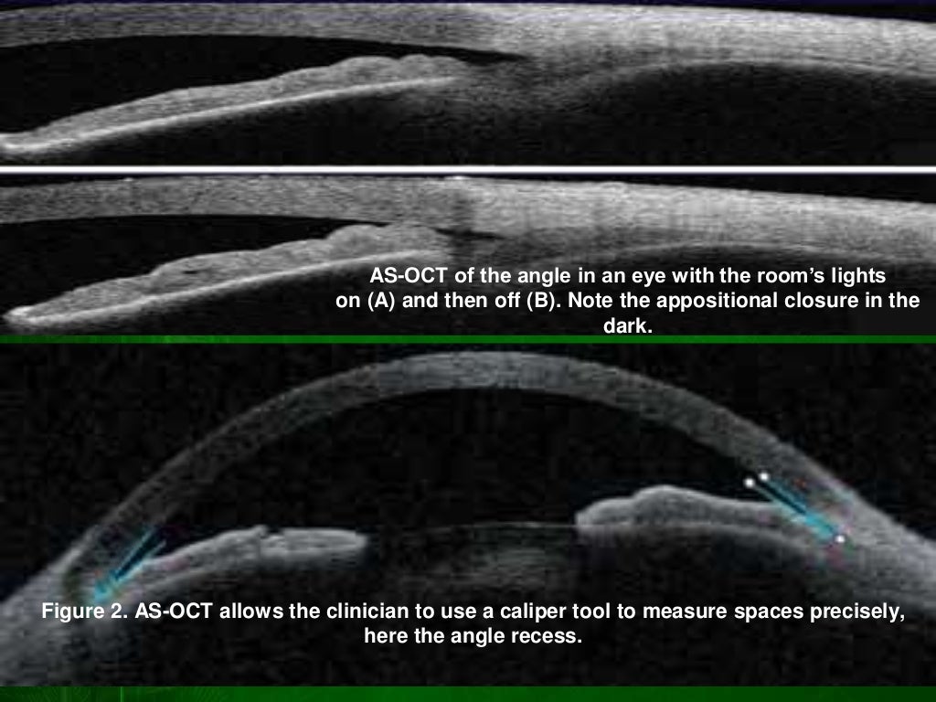 Role of oct in glaucoma